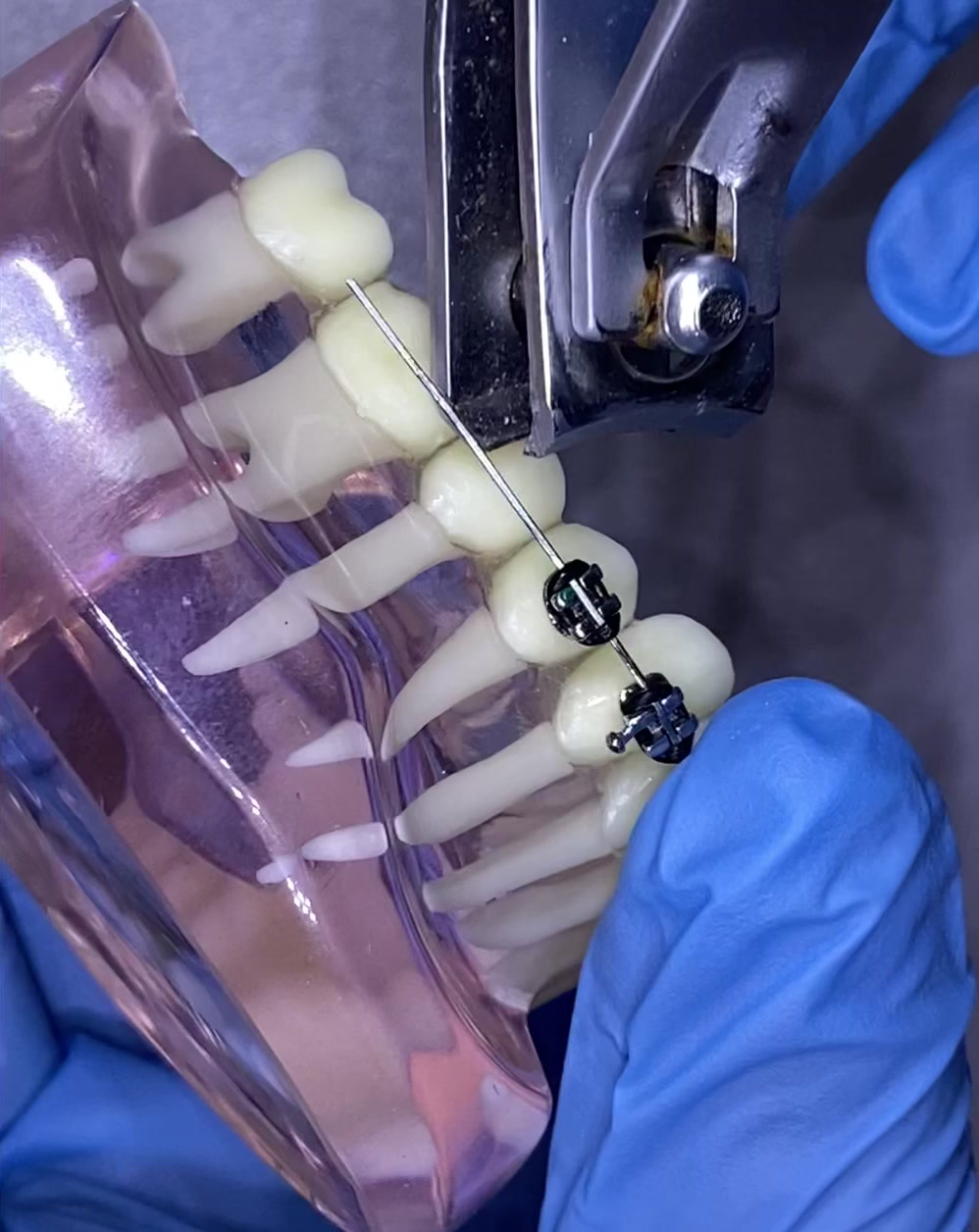 Comment couper un arc qui blesse - DentoMax